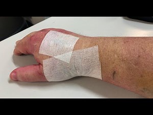 CMC Trapeziectomy Suspenionplasty Day 14 #surgeryrecovery #surgerysuccess