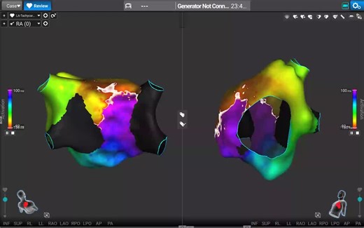 #medtronic #affera #electrophysiology #innovation #ablation #pfa #patientcare | Bryan Johnson