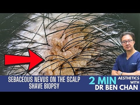 Sebaceous nevus on the scalp shave biopsy