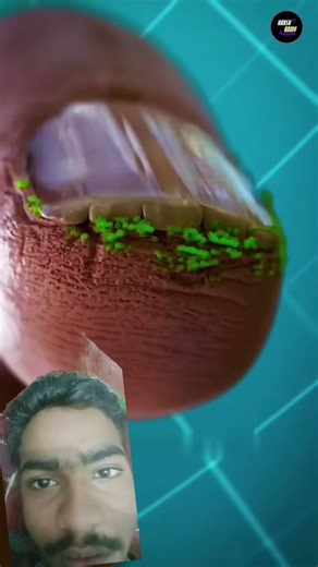 👉 What is Ingrown Nail? Causes, Symptoms & Complete Treatment | Ingrown Toenail#viralvideo #shorts