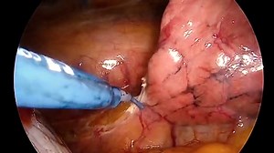 M - How to optimize your set-up for a VATS right upper lobectomy