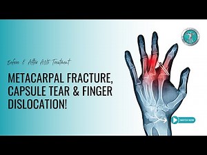 Metacarpal Fracture, Capsule Tear & Finger Dislocation : Before & After ANF Treatment