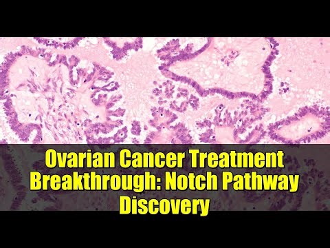Ovarian Cancer Treatment Breakthrough: Notch Pathway Discovery
