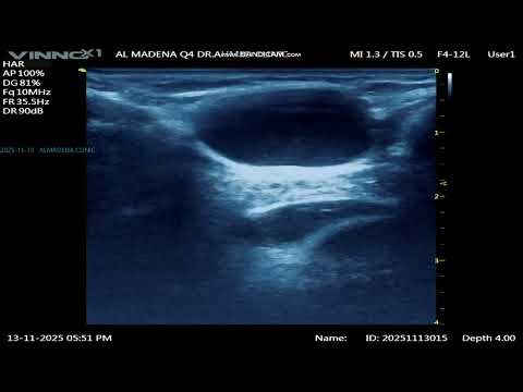 NECK : SUPRA -STERNAL CYST 2025 11 13 17 45