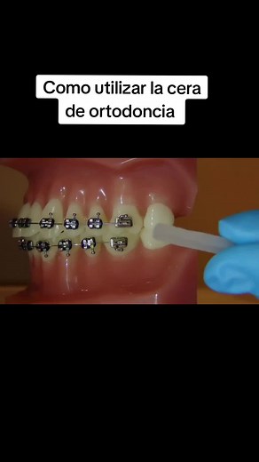 Cómo utilizar la cera en Ortodoncia