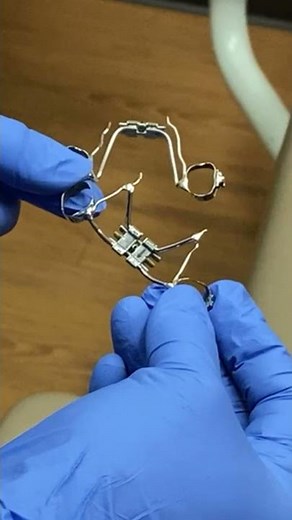 Orthodontic appliances 11 year old patient - RPE Upper and Lower - Tooth Time Family Dentistry