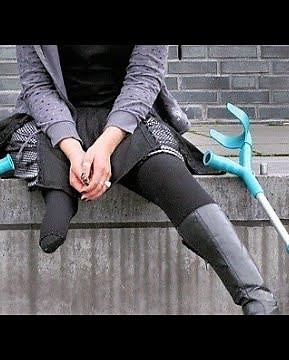 The beautiful woman with short legs walks with an artificial leg to compensate for her short leg