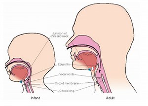 Pediatric Airway Management in the Emergency Department