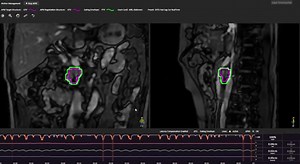 20 reactions | Automatic gating without the need for difficult-to-tolerate breath holds. At UMC Utrecht, upper-abdominal #cancer patients can now keep their normal breathing pattern during gated treatments on Elekta Unity MR-Linac. Hear benefits straight from the UMCU team ➡️ https://bit.ly/3IxU4d1 #radonc #radiotherapy #oncology | Elekta | Facebook
