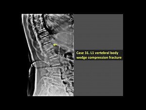 L1 Vertebral Body Wedge Compression Fracture (X-Ray)