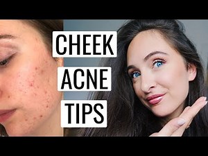 Tips To Get Rid Of ACNE ON YOUR CHEEKS 💡
