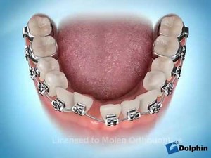Single Lower Incisor Extraction