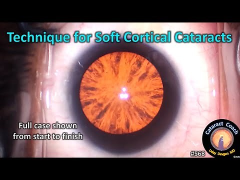 Complete Cataract Case: Technique for Soft Cortical Cataracts