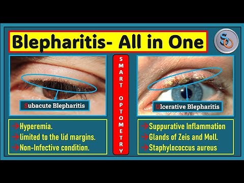 Blepharitis- Definition, Causes, Types, Symptoms, Signs, Treatment & Complications.