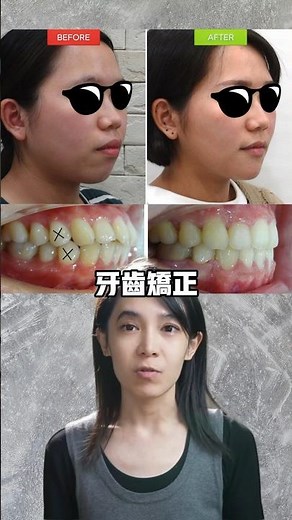 牙齒整齊，咬合超好，還要戴牙套🤔？#骨性暴牙#嘴凸矯正#牙齒矯正