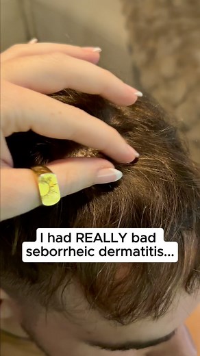 Seborrheic dermatitis - it’s more than just dandruff. The redness, flakes, itch and irritation that never seem to go away… it’s exhausting. 😣 We get it. That’s why we created the our Scalp Relief Routine - designed to bring balance and comfort back to your scalp. 💧 Step 1: Oil – Massage in to soften build-up and hydrate dry, irritated areas. 🧴 Step 2: Cream – Leave on to calm and moisturise sensitive, reactive skin. 🚿 Step 3: Shampoo – Gently cleanse and refresh without stripping or harsh ch