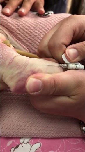 Why do they prick a baby's foot? The Heel Stick Test!
