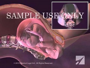 Childbirth - Normal Vaginal Delivery