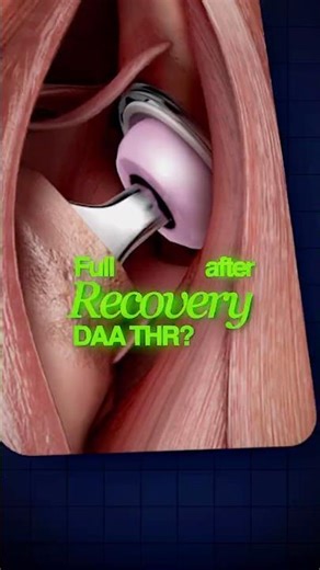 Recovery from DAA hip replacement #directanteriorhipreplacement