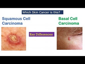 Skin Cancer! Squamous Cell Carcinoma vs Basal Cell Carcinoma | How to differentiate Clinically?