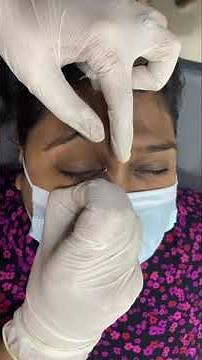 Sebaceous cyst removal very close to the eye. Follow on insta @dermatologist.drsonam #pimplepopper