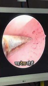 Opening completely blocked tubes!