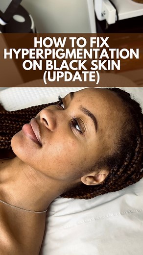6.4K views · 46 reactions |  UPDATE VIDEO - How to Fix Hyperpigmentation on Black Skin Part 2 This is our beautiful clients second session & already dark marks are beginning to fade! We now also offer CHEMICAL PEELS in Clinic to also help get BETTER results for our darker skin tone clients :) #pico #skincare #london #hyperpigmentation #darkspots #acne #skincaretips #darkmarks #acne #acnescars #reel #viral | Blueness By Oceania Aesthetic Clinic | Facebook