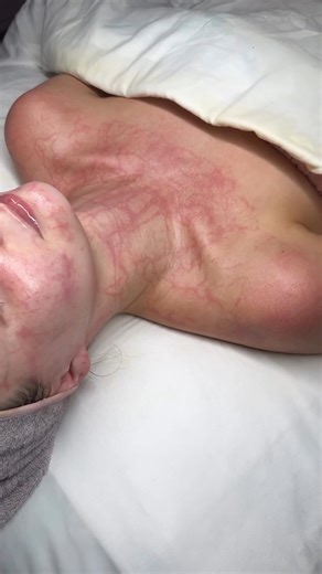 The temporary DMK Plasmatic effect that occurs after an Enzyme treatment showcases the network of capillaries under the skin being flooded with fresh, oxygenated blood: visible proof of the rebuilding phase of skin revision below the surface! This rush of oxygenation also helps stimulate the lymphatic system, which doesn’t have its own method to push old lymph out of the system; instead, it relies on the surrounding musculature, which is why the rush of blood is so effective in helping clear the
