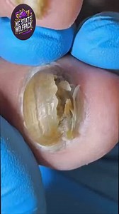 241K views · 859 reactions | Recommended diabetic foot safety tips, calm and clear #SimpleNailCare #HealthyNails #NailCareTips | NC State Wolfpack on TheWolfpacker.com | Facebook