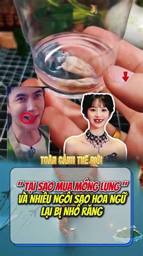 Nguyên nhân ngôi sao Hoa Ngữ bị nhổ răng: Sự thật