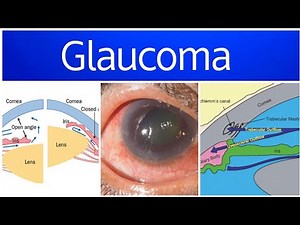 Glaucoma 2 | Diagnosis, Visual Field Defects