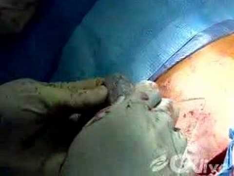 Automated Implantable Cardiac Defibrillator