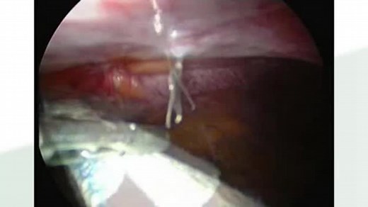 PROCEED Surgical Mesh | Ethicon