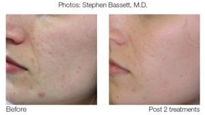 eMatrix Sublative Skin Rejuvenation | Laser Skin Resurfacing Camarillo