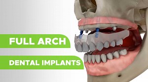 159K views · 1.2K reactions | Full Arch Dental Implants Straumann Pro Arch Enables Personalized Treatment Protocols for Implant Borne Fixed Full Arch Dental Restorations. | SurgMedia | Facebook