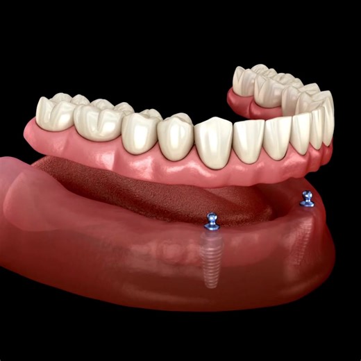 ‼️Delray Beach‼️ Dr. Dahms is looking for 50 new patients to handle their smile makeover needs with our limited time Snap In Denture Savings Promotion. 😁 We want 50 people in our community to gain a smile they can be proud of through our limited time Snap In Dentures promotion.🙌 Dr. Dahms and his staff take pride in their ability to help patients with all their dental needs and help them gain a smile makeover. ✅ Come see why so many people in Delray Beach take advantage of our denture program 