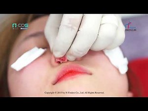 Nose PDO thread lift Technique _Case 2 | N-Cog Y-KO