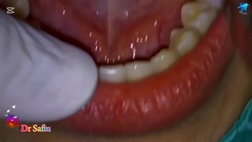 Class V Composite Restoration Techniques