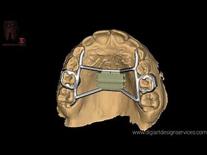 Exocad : Hyrax Expander Design for a Dental Lab