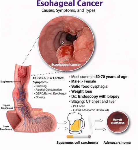 Vivek Kumar Sahu on Instagram: "Esohageal Cancer: Causes, Symptoms, and Types Esophageal cancer is a malignant tumor arising from the lining of the esophagus. It is aggressive and often diagnosed late due to vague early symptoms.. @microbiologynotes . . . . . . . . . #esohagealcancer #cancerstudy #cancerawerness #medicalawareness #microbiologist"