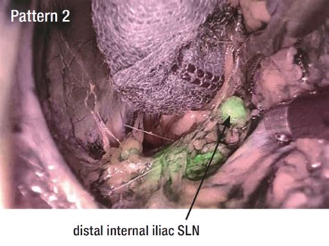 Sentinel Lymph Node Identification In Prostate Cancer Using Ir