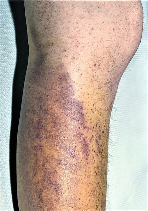 Bruise Like Rash