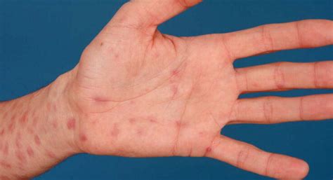 What Are The Symptoms Of Syphilis Rash And The Treatment For Syphilis Rash Health And Detox