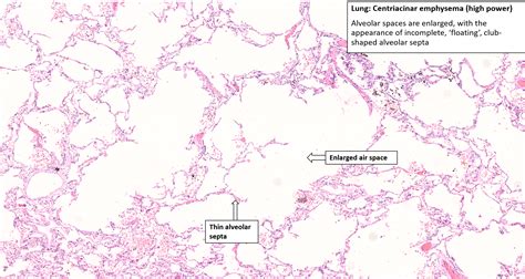 Emphysema Vs Normal Lung Histology My Xxx Hot Girl