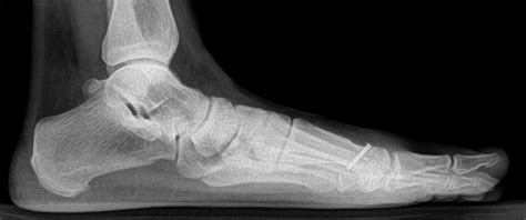Digital X Ray Treatment Foot Doctor Southlake Keller Flower Mound North Richland Hills And