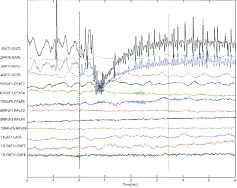 figure 2 2 from automatic detection of epileptic seizure onset and termination using