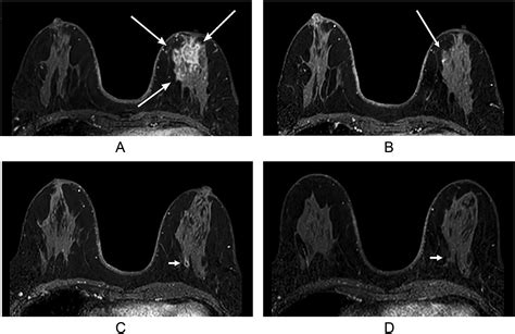 Ring Enhancement In Non Neoplastic Breast Tissue On Mri During Neoadjuvant Chemotherapy For
