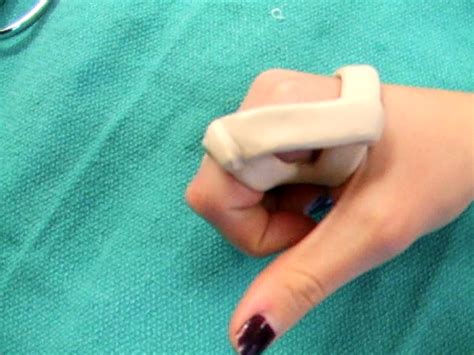 Principles Of Splinting Splinting In Wrist And Hand Conditions