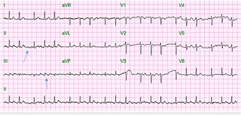 Ekg On The Th Day Of Hospitalization Showing Atrial Flutter With