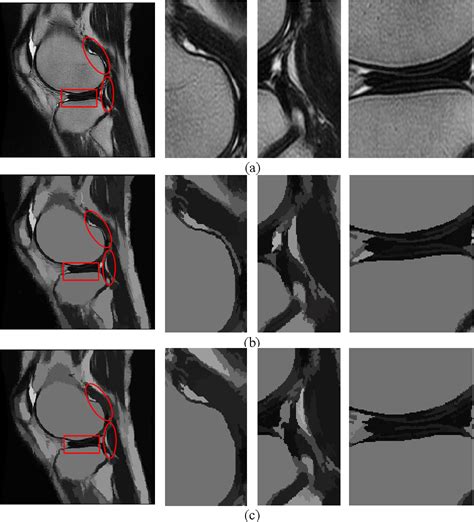 figure 5 from medical image segmentation using mean shift algorithm and general edge detection